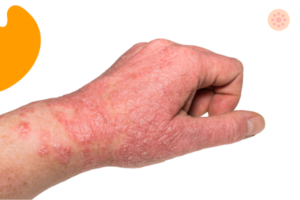 Psoriasis en manos y pies: causas, síntomas y tratamiento - SKASKAHS